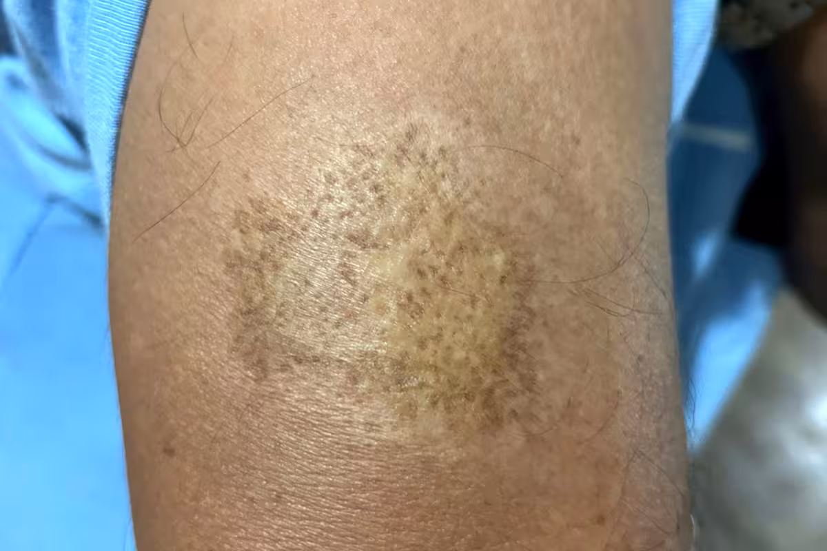 Leishmaniasis: Registran 16 casos en Felipe Carrillo Puerto y José ...