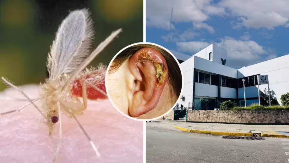 Ahora en Campeche confirman cuatro casos de Leishmaniasis, enfermedad ...